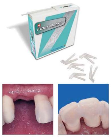 Clip&Splint 30 (Polydentia)