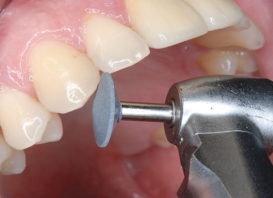 Ceramaster HP (Shofu)