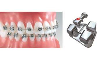 Brackets | Sky Dental Supply